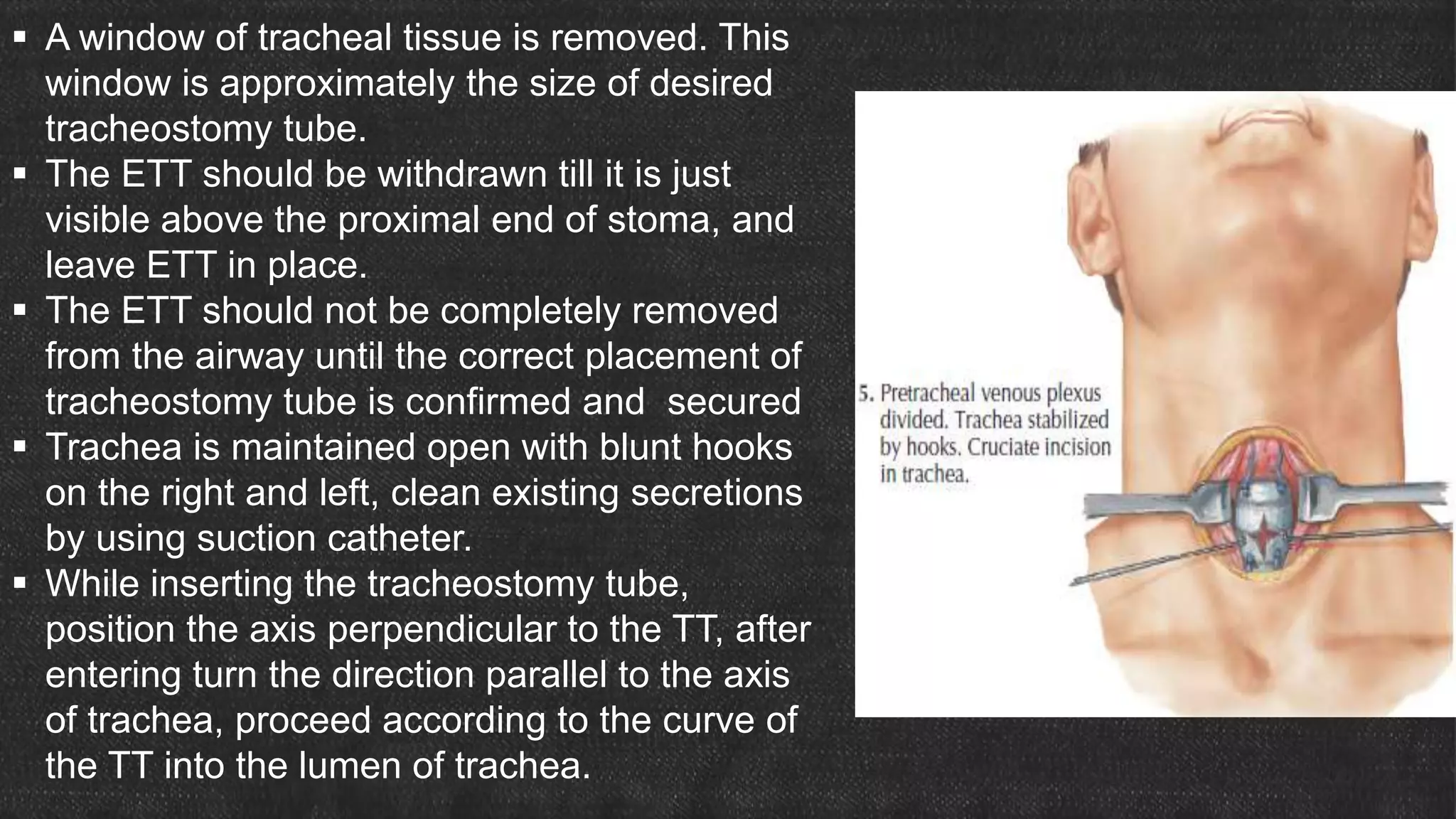 Tracheostomy | PPTX | Lung and Respiratory Health | Diseases and Conditions