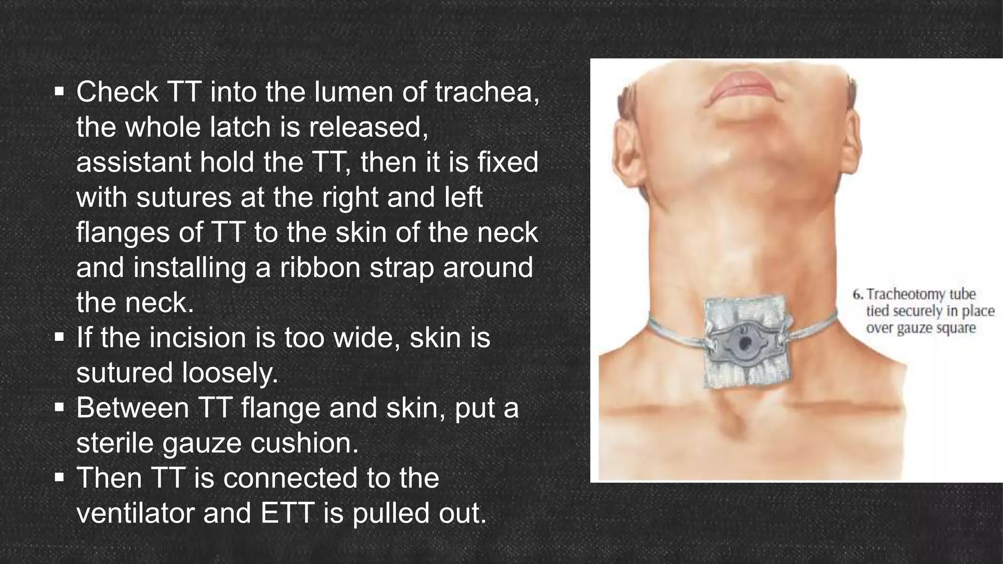 Tracheostomy | PPTX | Lung and Respiratory Health | Diseases and Conditions