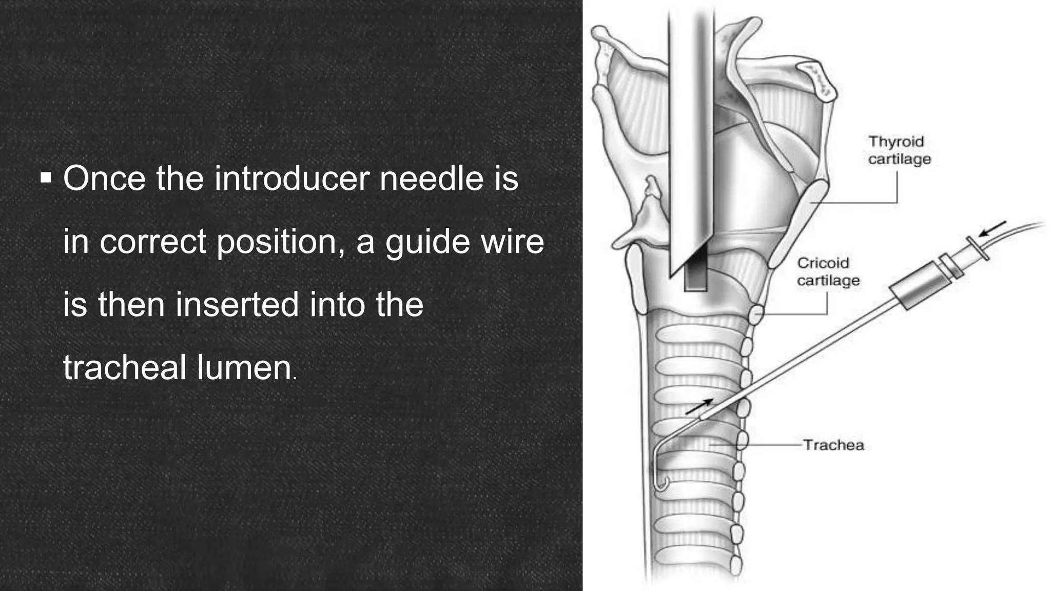 Tracheostomy | PPTX | Lung and Respiratory Health | Diseases and Conditions