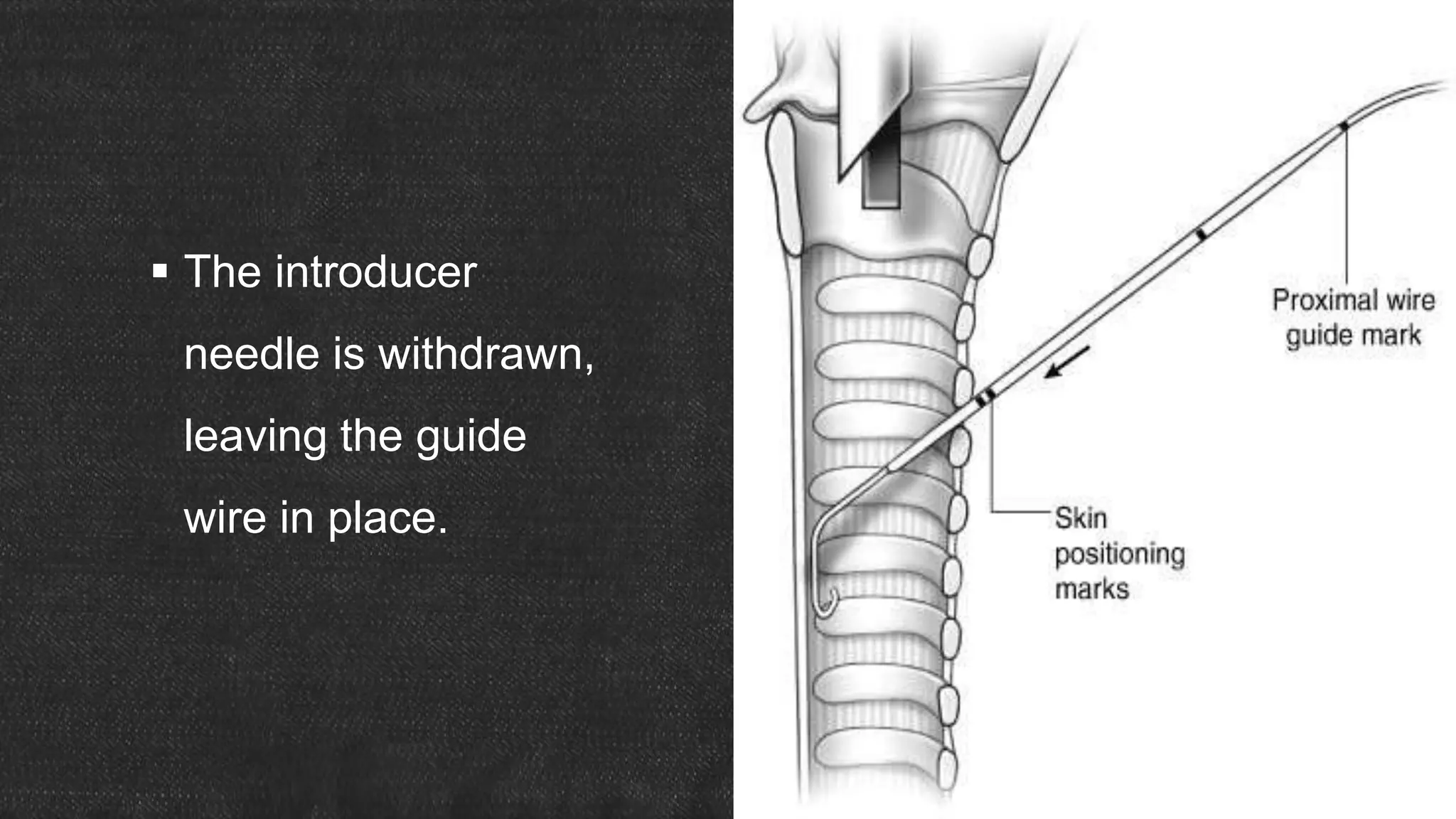 Tracheostomy | PPTX | Lung and Respiratory Health | Diseases and Conditions