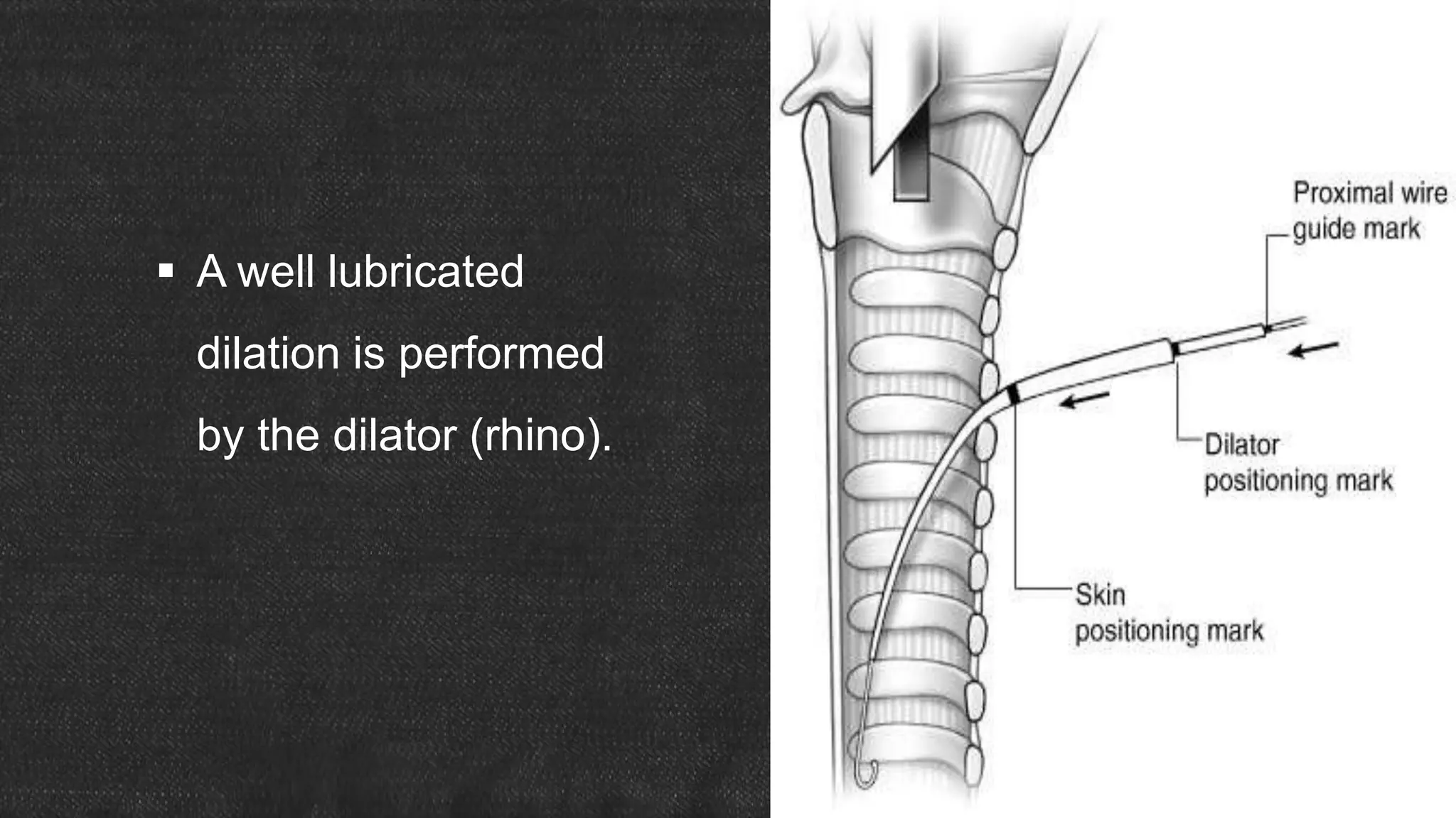 Tracheostomy | PPTX | Lung and Respiratory Health | Diseases and Conditions