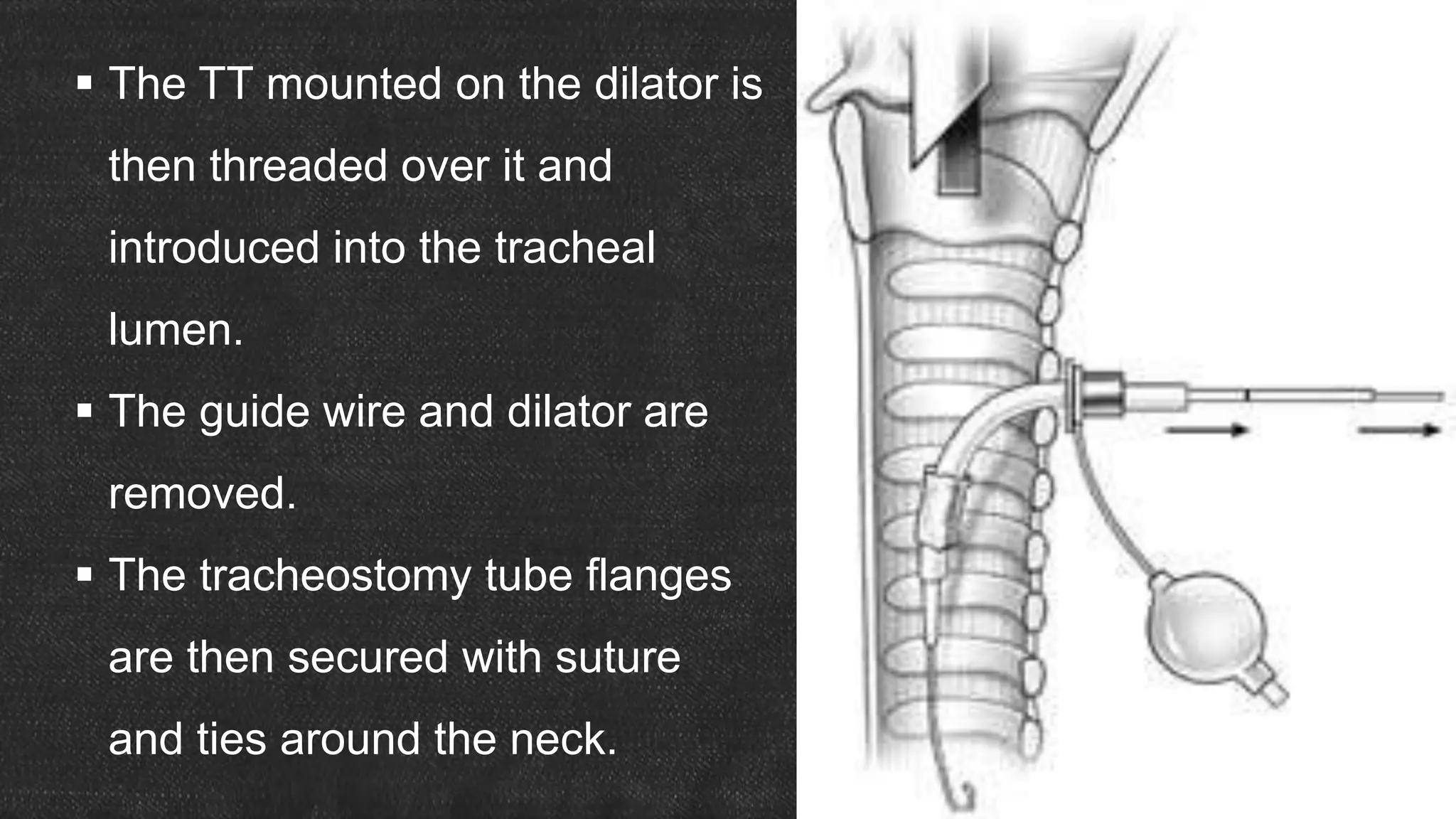 Tracheostomy | PPTX | Lung and Respiratory Health | Diseases and Conditions