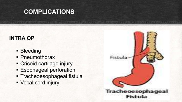 Tracheostomy | PPTX | Lung and Respiratory Health | Diseases and Conditions
