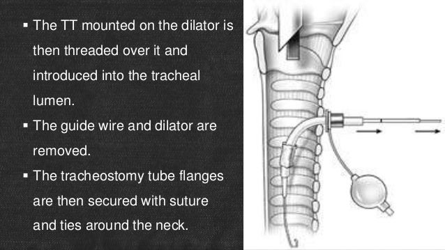 Tracheostomy