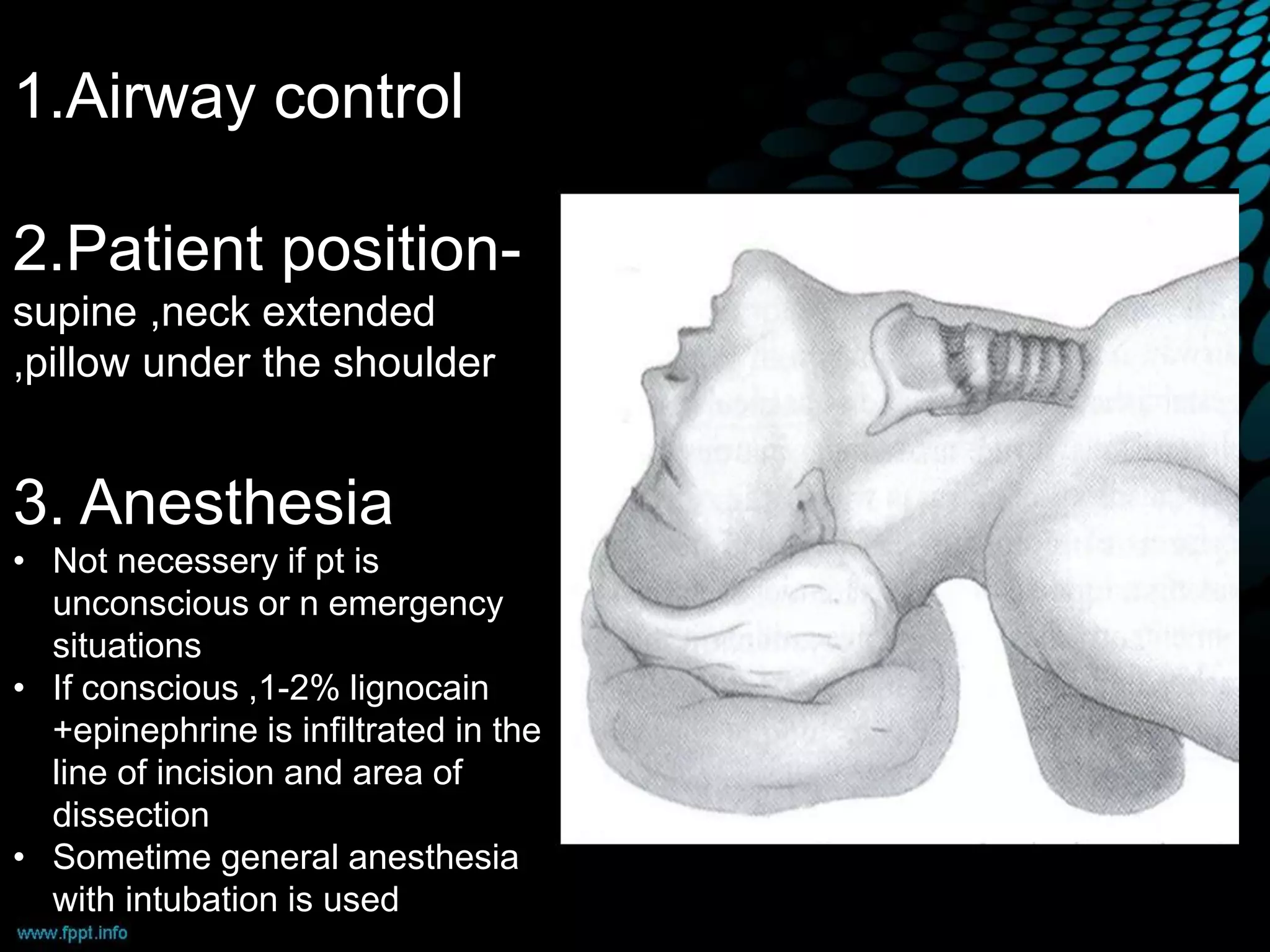 Tracheostomy | PPTX