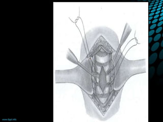 Tracheostomy | PPTX