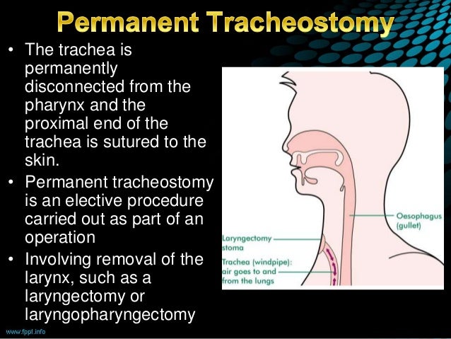 Tracheostomy