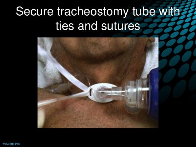 Tracheostomy