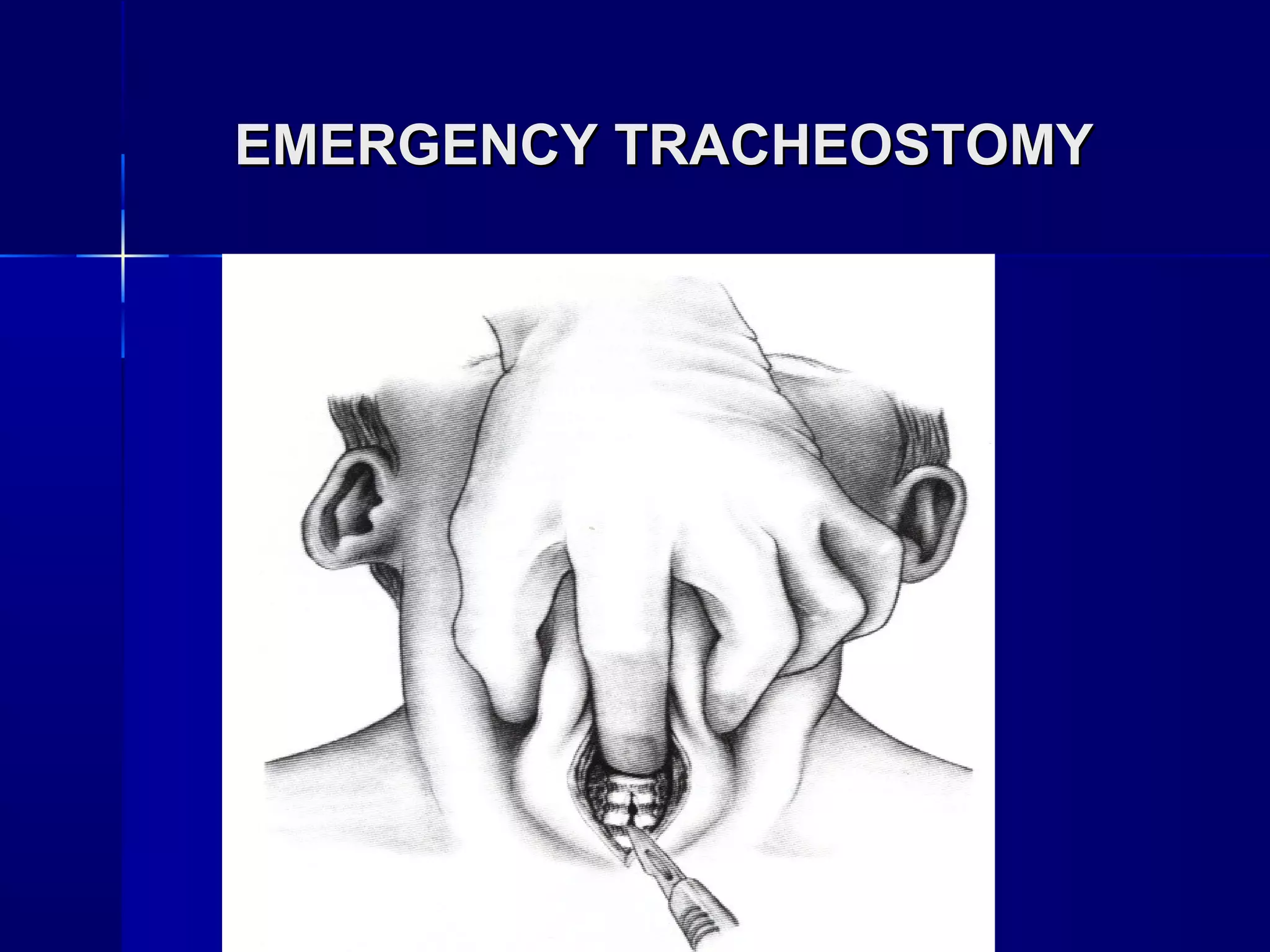 Tracheostomy | PPT