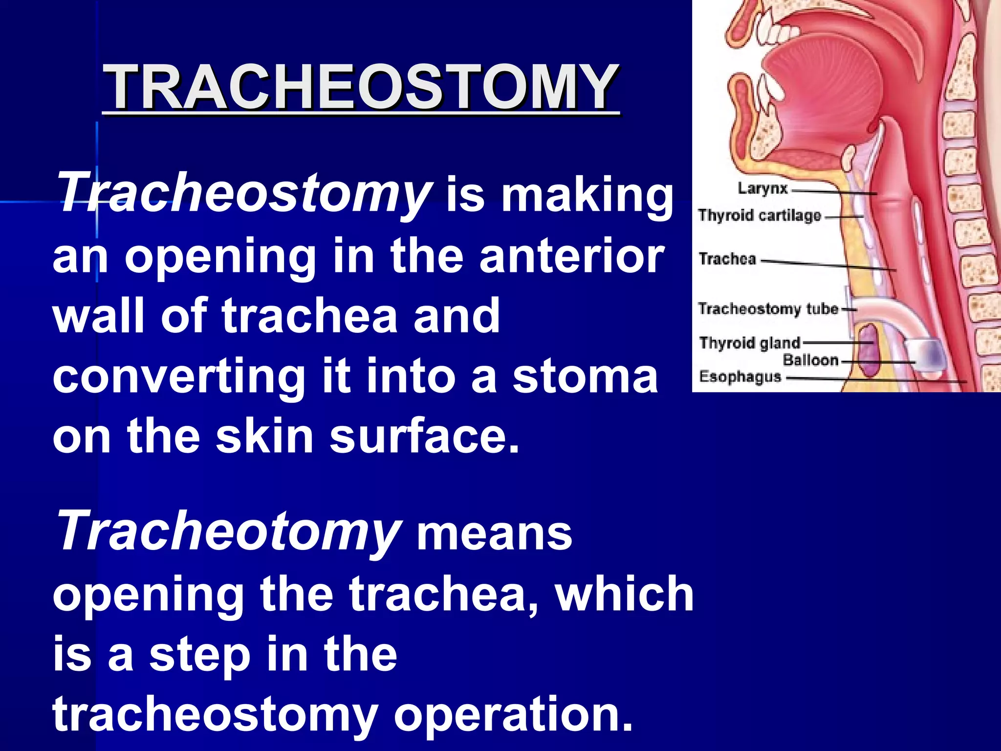 Tracheostomy | PPT