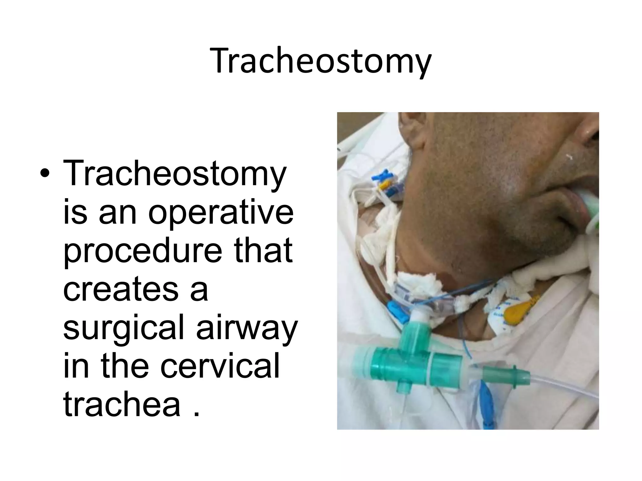 Tracheostomy | PPTX