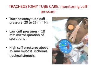 Tracheostomy | PPT