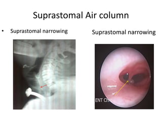 Tracheostomy | PPTX