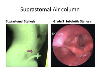 Tracheostomy | PPTX