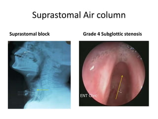 Tracheostomy | PPTX