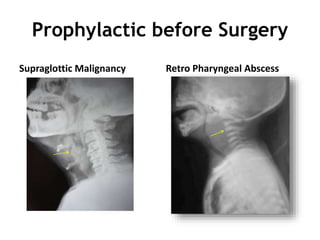 Tracheostomy | PPTX