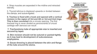 Tracheostomy | PPT