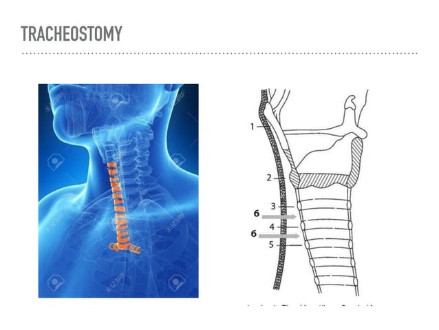Tracheostomy Care | PDF