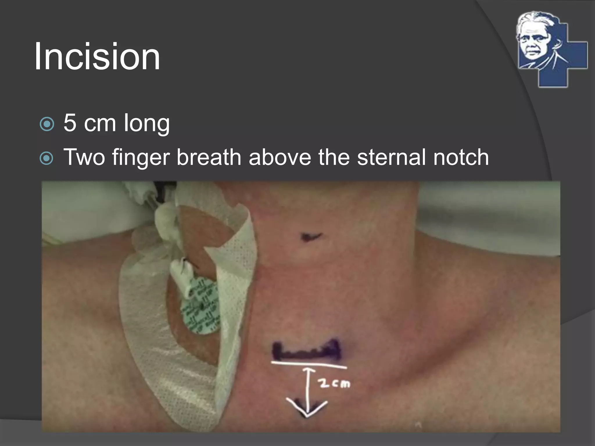 Tracheostomy | PPTX