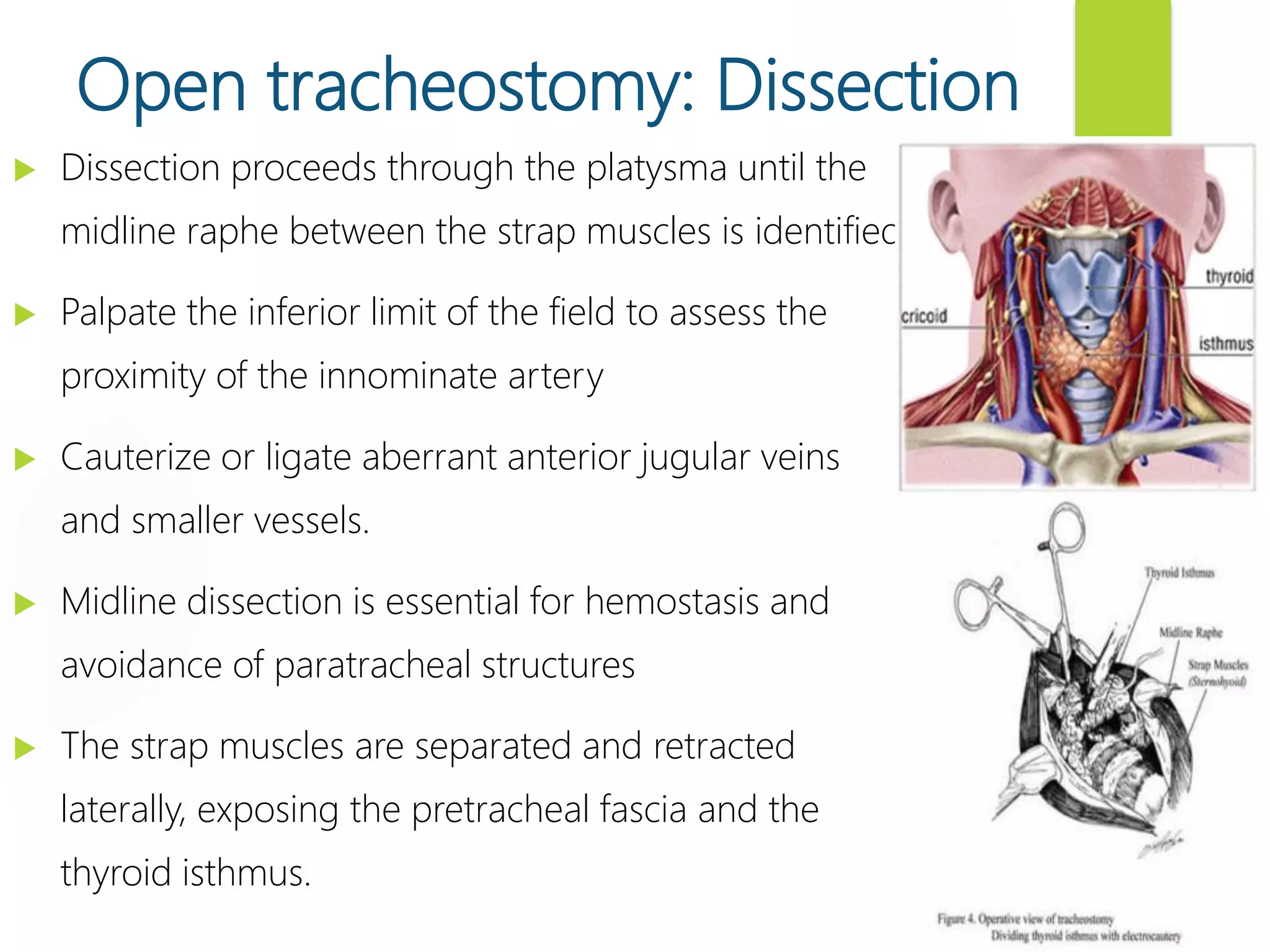 Tracheostomy | PPTX