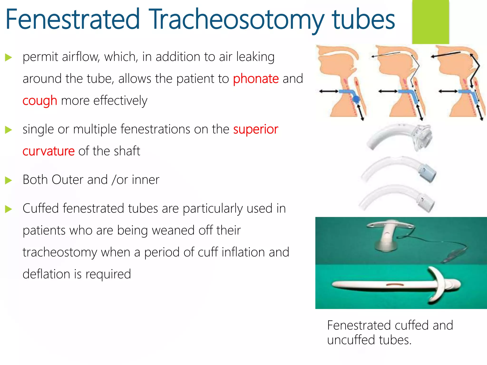 Tracheostomy | PPTX