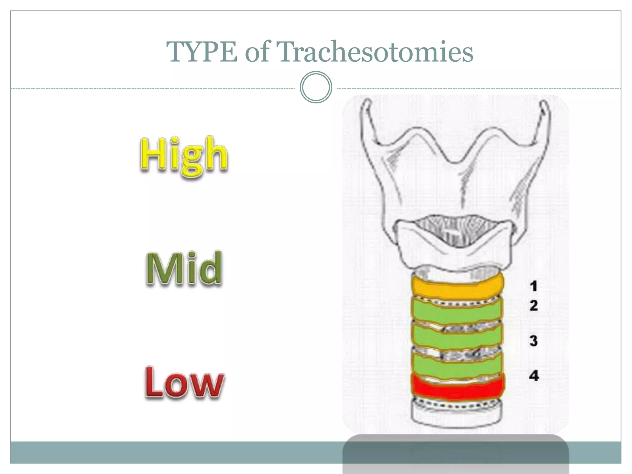 Tracheostomy | PPTX
