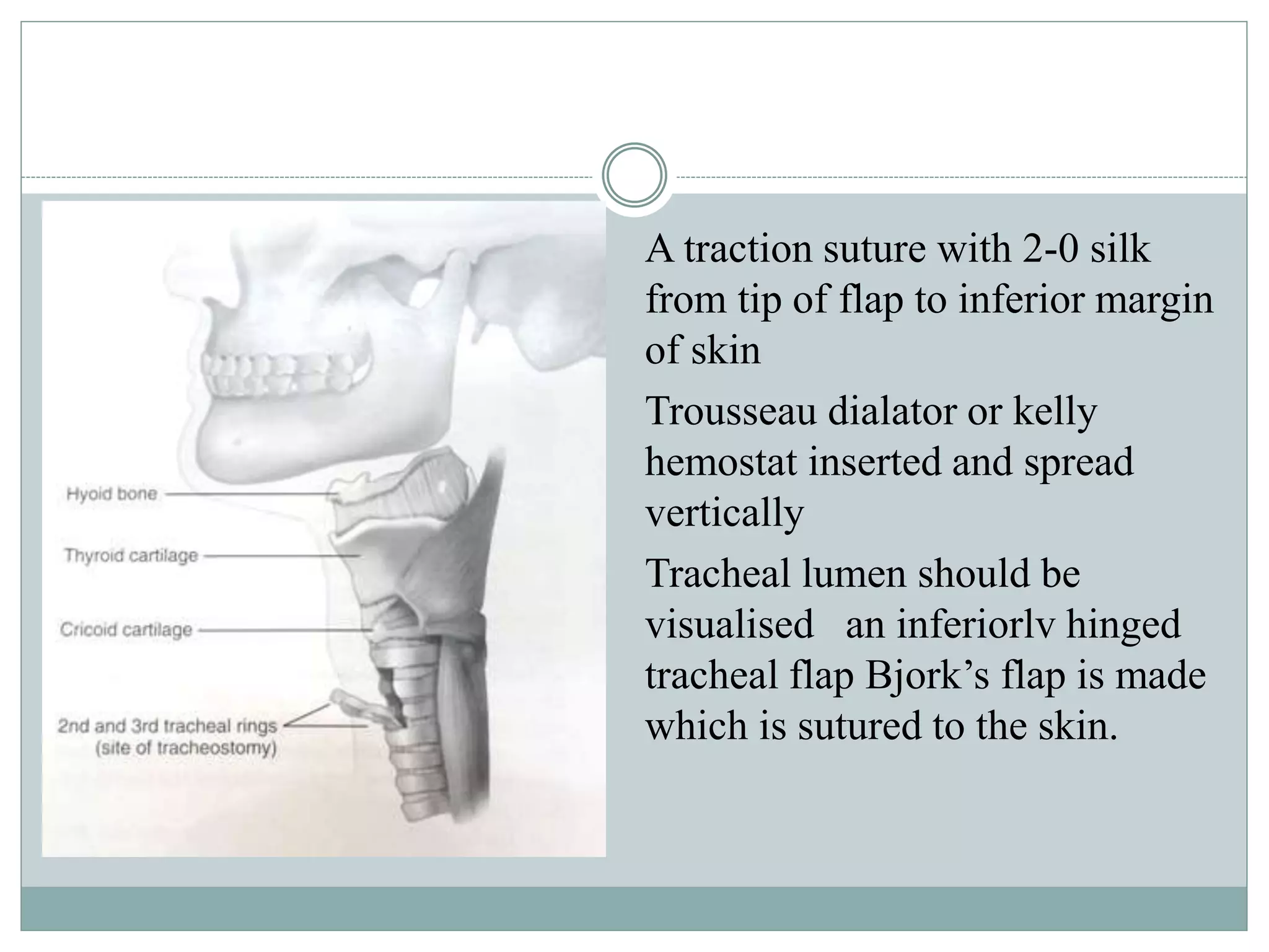 Tracheostomy | PPTX