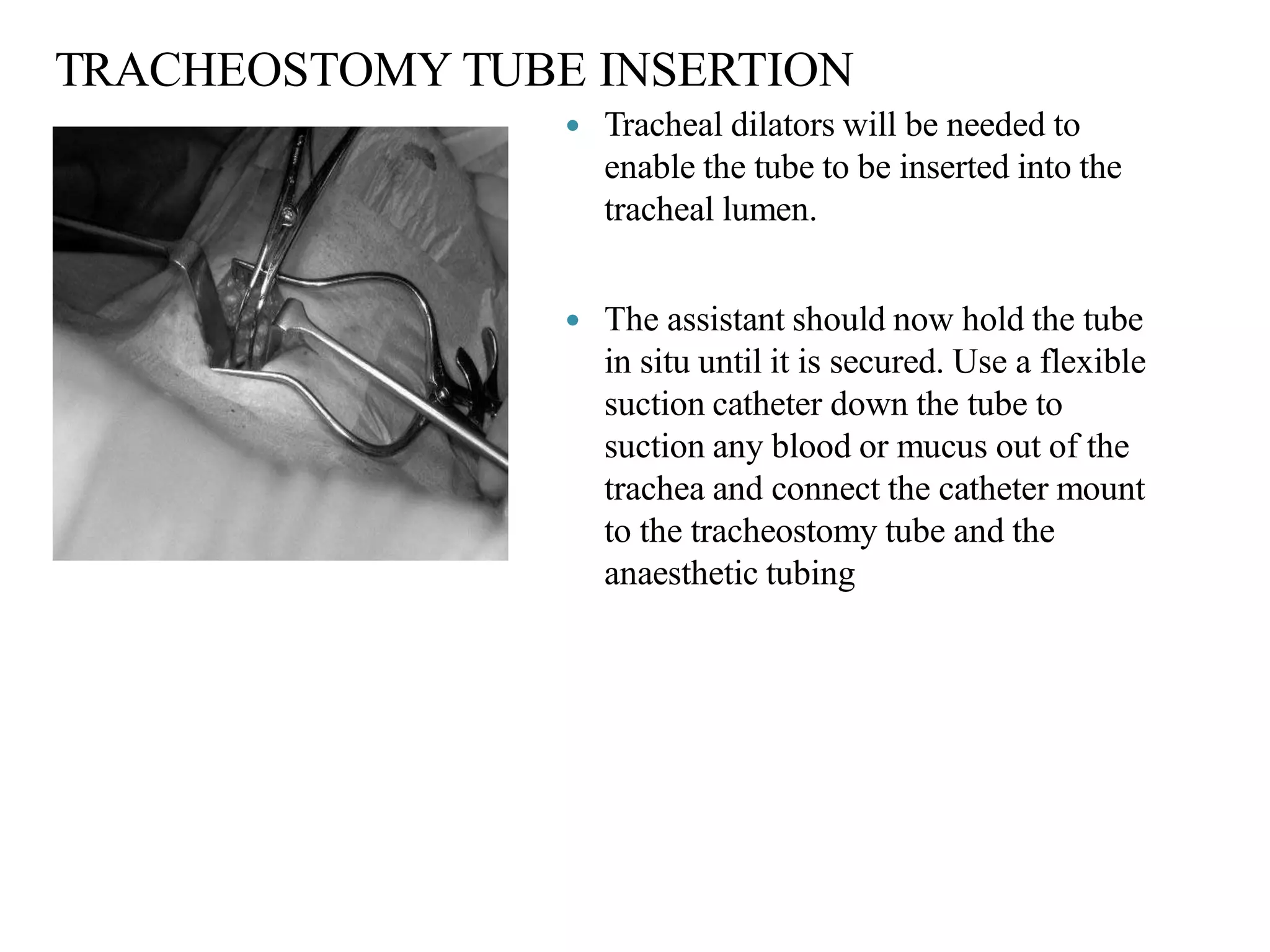 Tracheostomy | PPTX