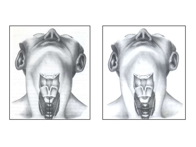 Tracheostomy | PPTX | Ear, Nose and Throat Conditions | Diseases and ...