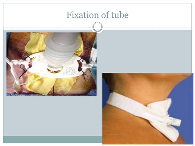 Tracheostomy | PPTX | Ear, Nose and Throat Conditions | Diseases and ...