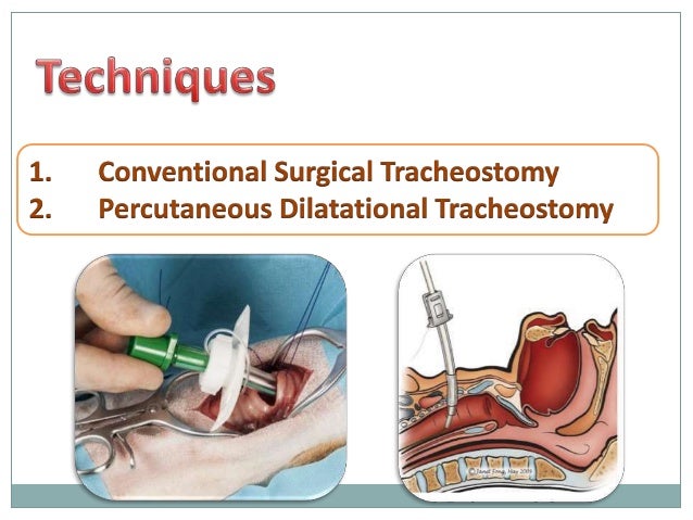 Percutaneous Tracheostomy