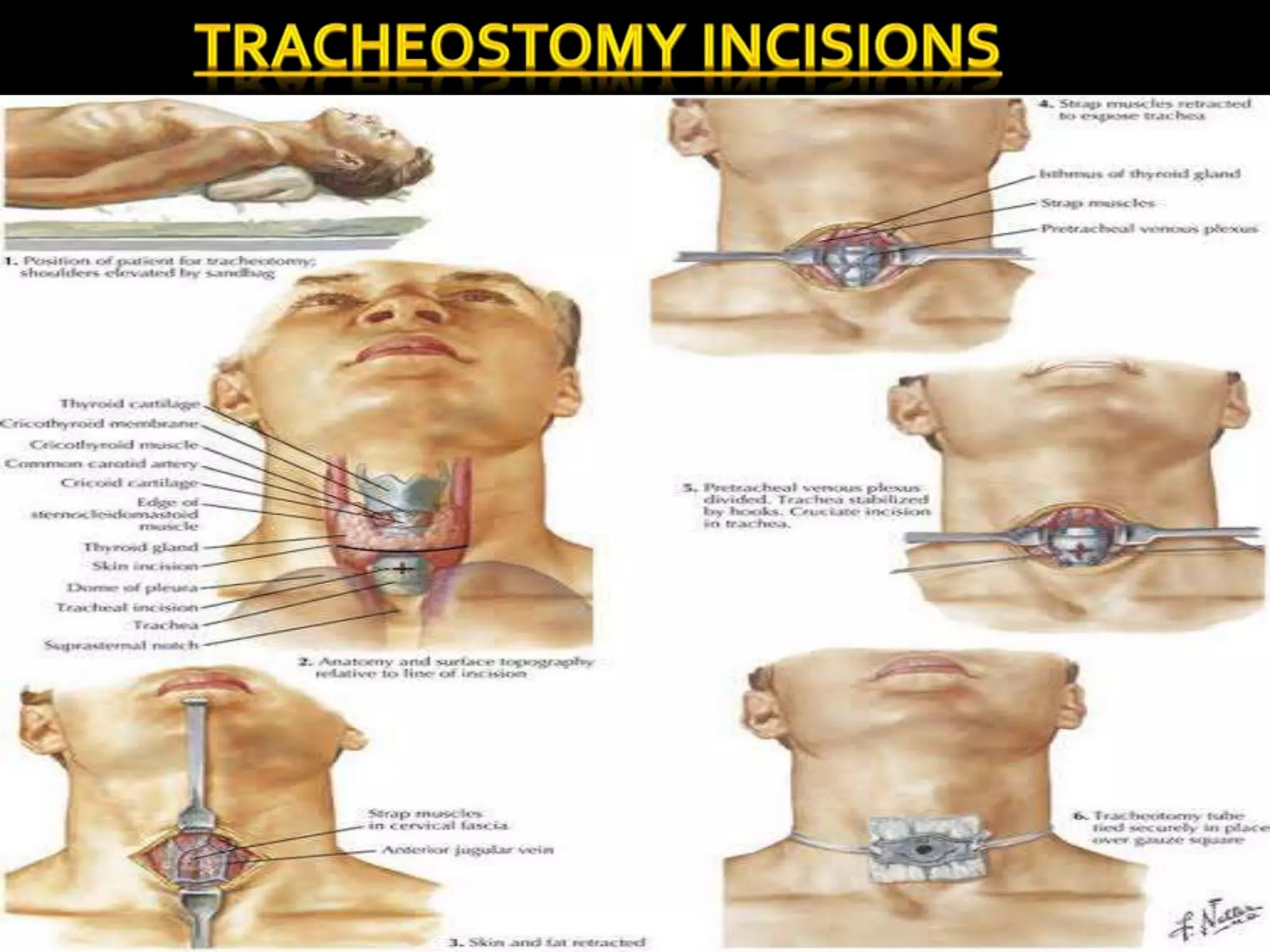 Tracheostomy ( for medical students ) | PPTX