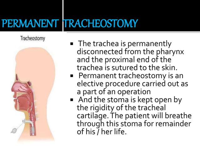 Tracheostomy ( for medical students ) | PPTX | Ear, Nose and Throat ...