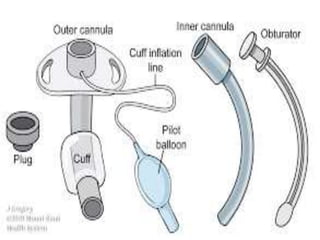 Tracheostomy Plug