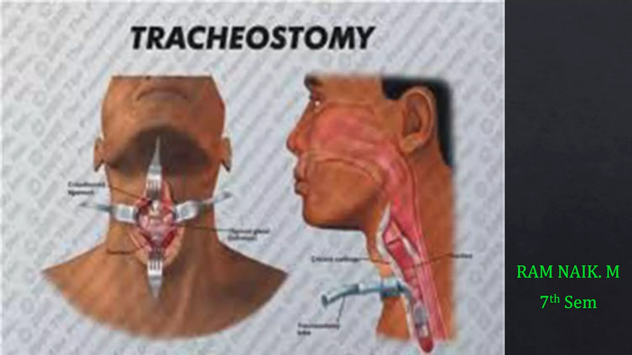 Tracheostomy | PPT