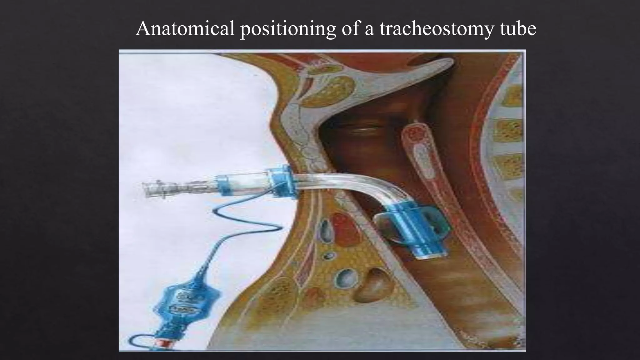 Tracheostomy | PPT