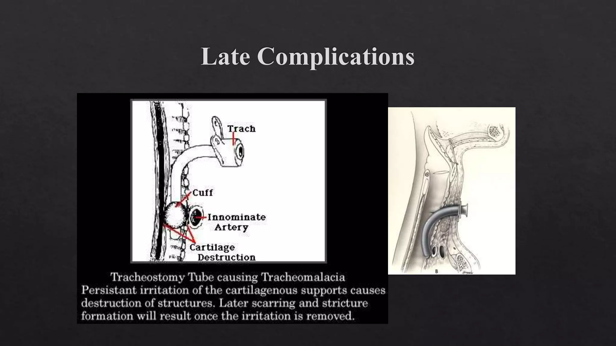 Tracheostomy | PPT