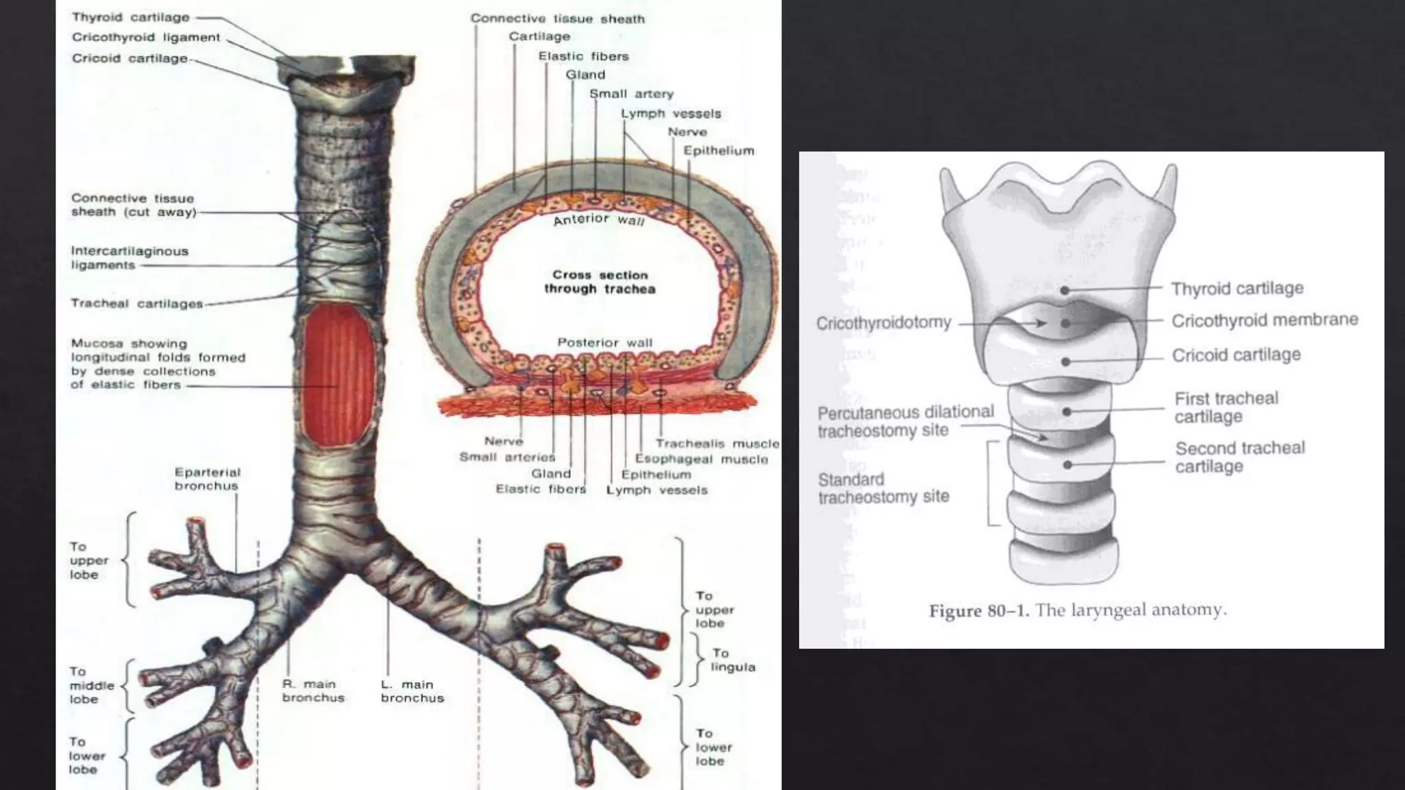 Tracheostomy | PPT