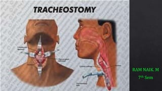 Tracheostomy | PPT