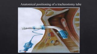 Tracheostomy | PPTX