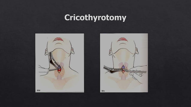 Tracheostomy | PPT