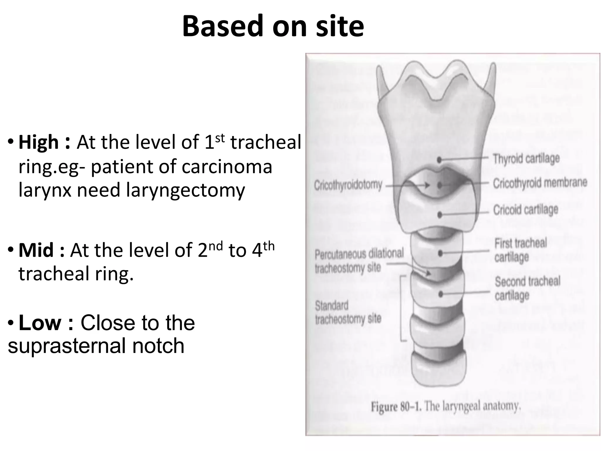 Tracheostomy | PPTX