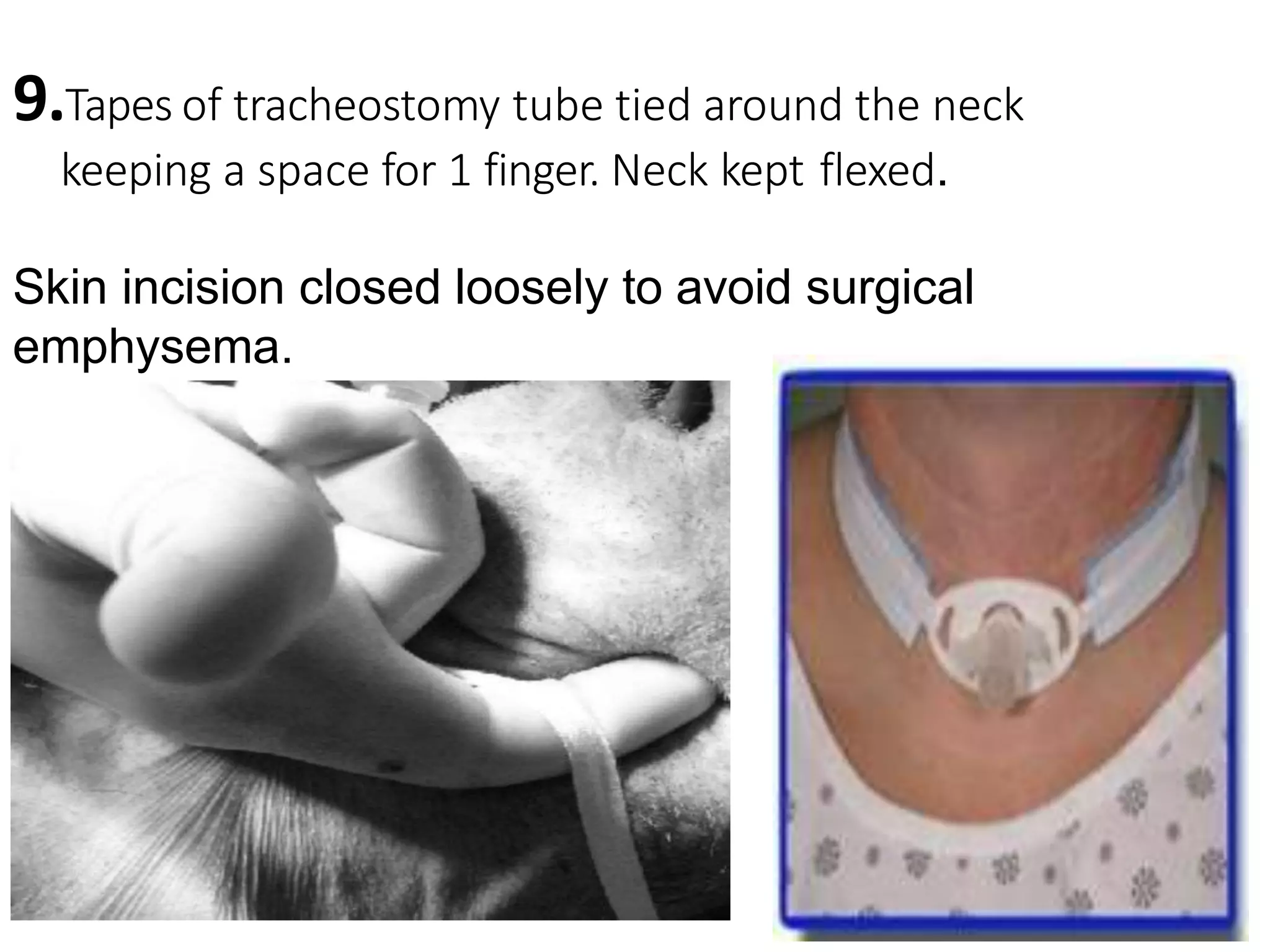 Tracheostomy | PPTX