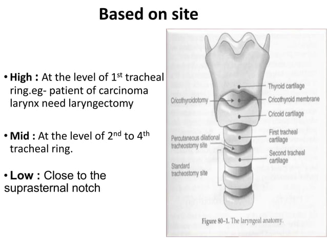 Tracheostomy | PPTX