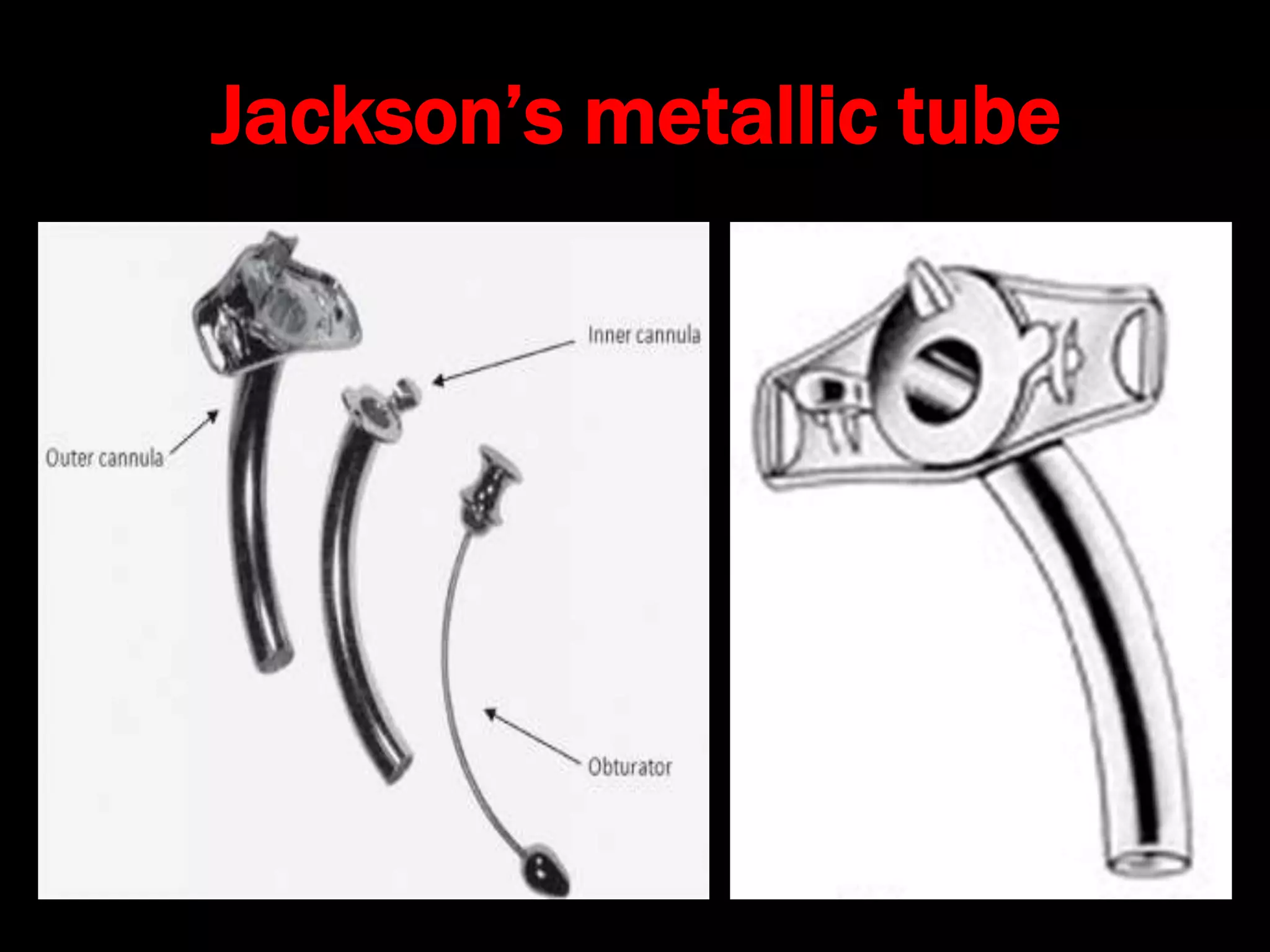 Tracheostomy: History, definition, indications, procedure ...