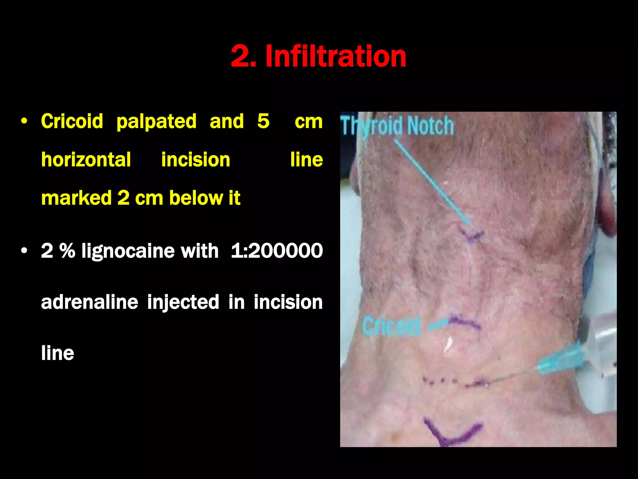 Tracheostomy: History, definition, indications, procedure ...