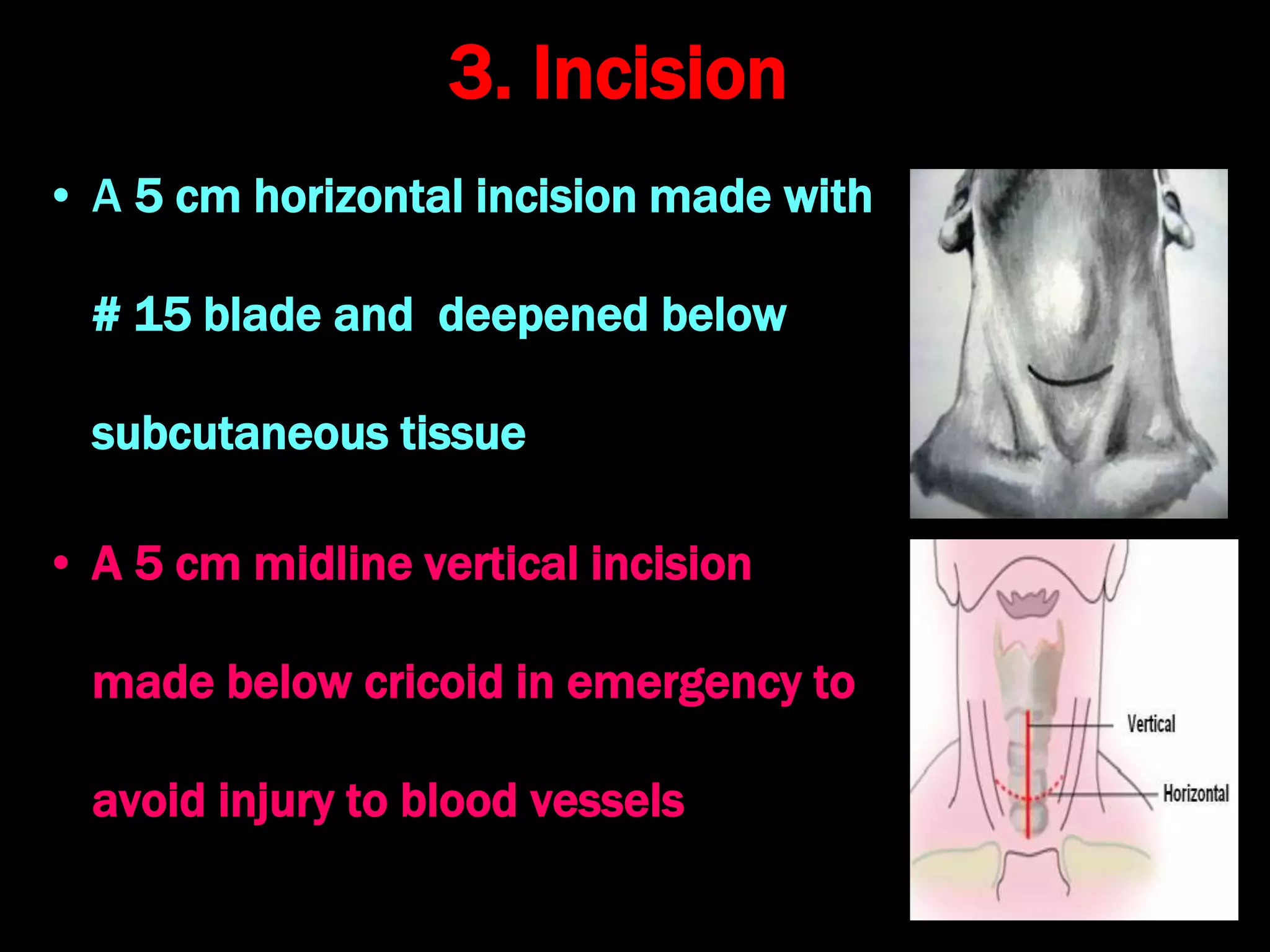Tracheostomy: History, definition, indications, procedure ...