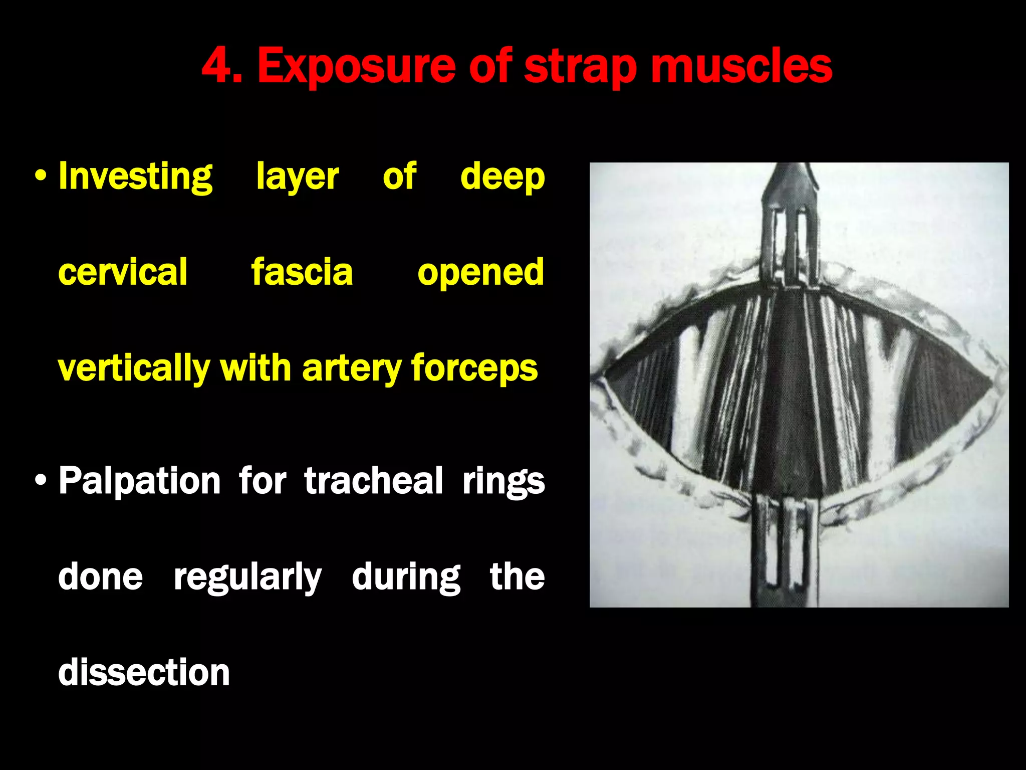 Tracheostomy: History, definition, indications, procedure ...