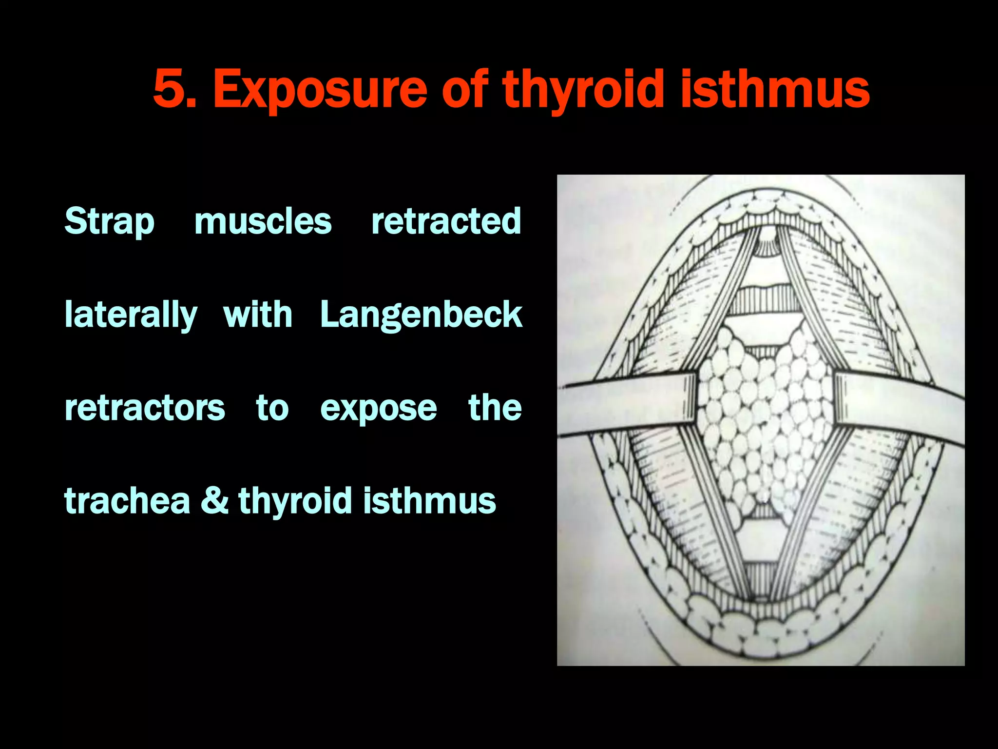 Tracheostomy: History, definition, indications, procedure ...