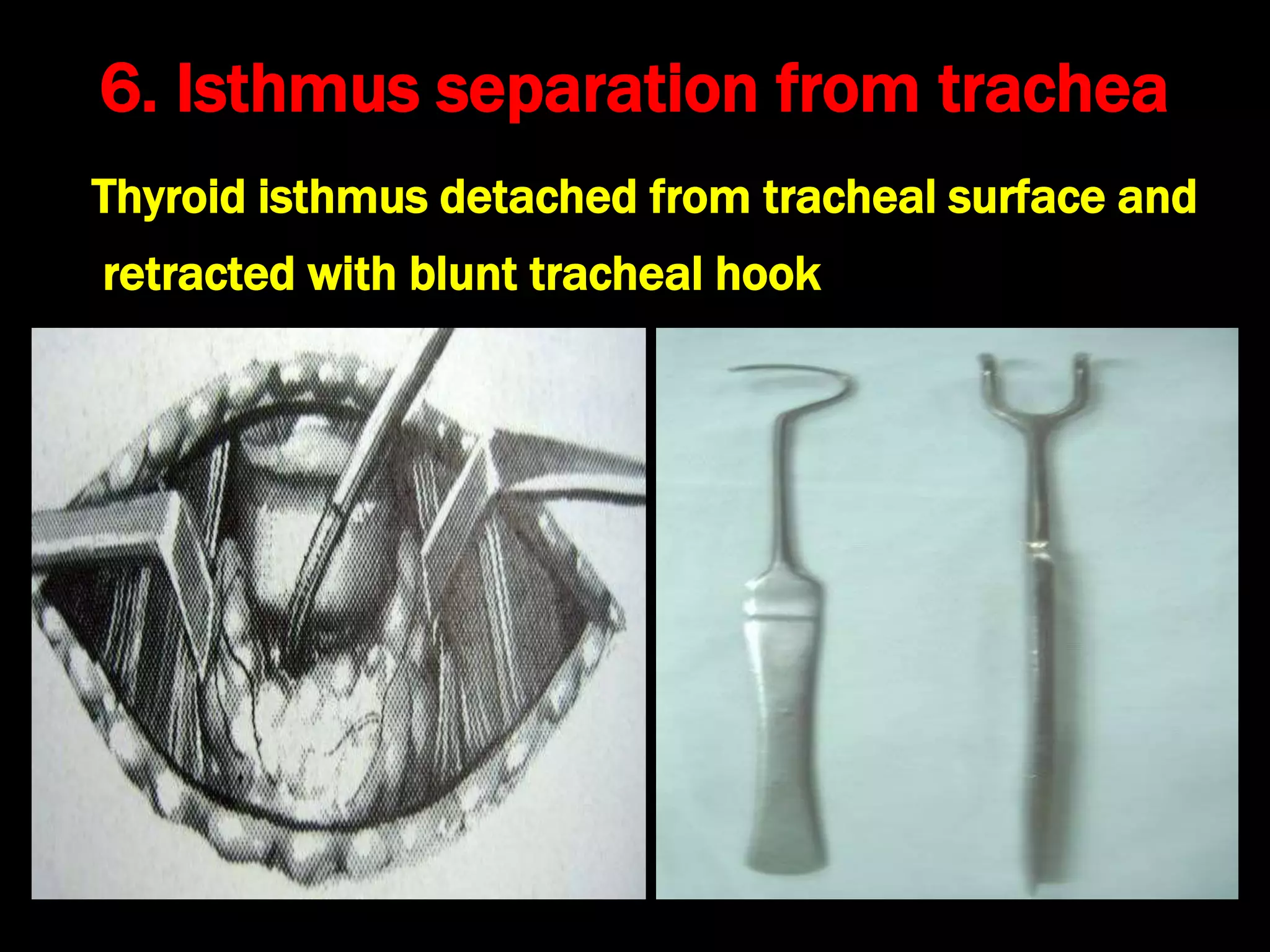Tracheostomy: History, definition, indications, procedure ...